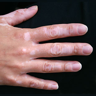 ¿Qué es la tiña versicolor? | Jabones Kleenex® México